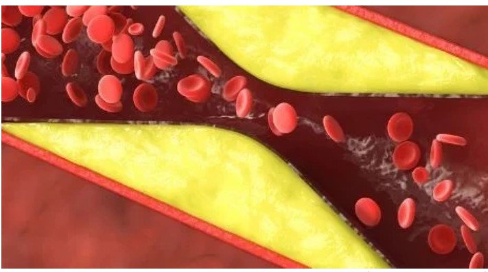 Coronary Plaques in "Healthy" People: A Silent Threat – Longevity Box